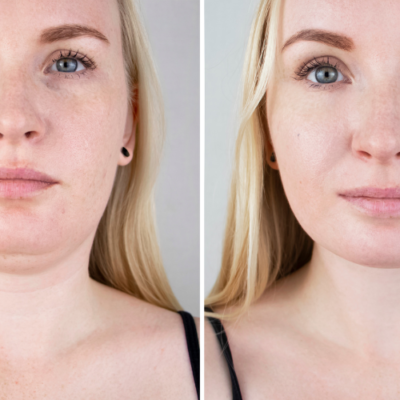 Choosing the Right Treatment for Double Chin Reduction - Aesthetic ...